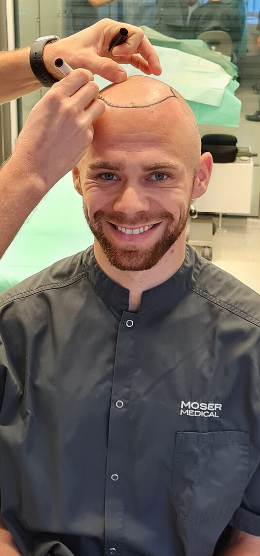 Haartransplantation von Alexander Schlager | Moser Medical